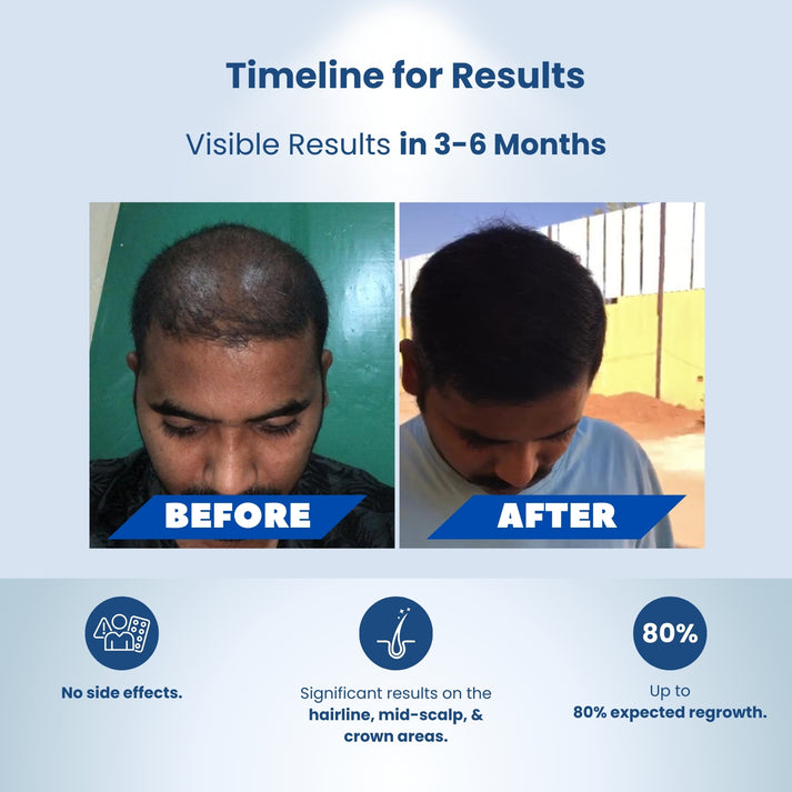 Adonsidil finstrong 2.5x solution WITH 150Rs Balayantra roller – Waidon